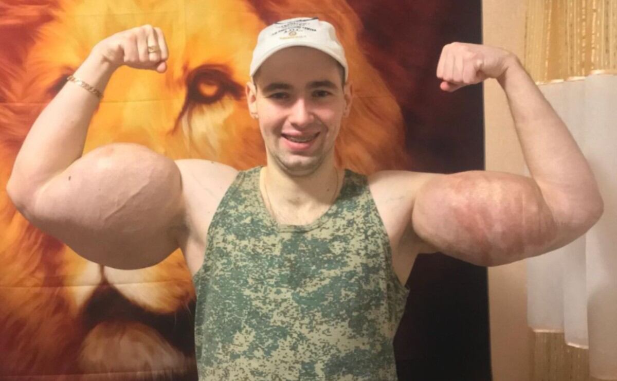 “Hulk ruso” opera sus músculos para salvar sus brazos y su vida | De10 ...